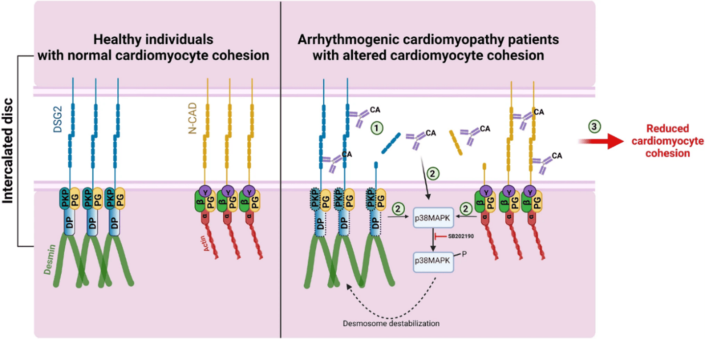 Novel pathomechanism discovered in patients with arrhythmogenic ...