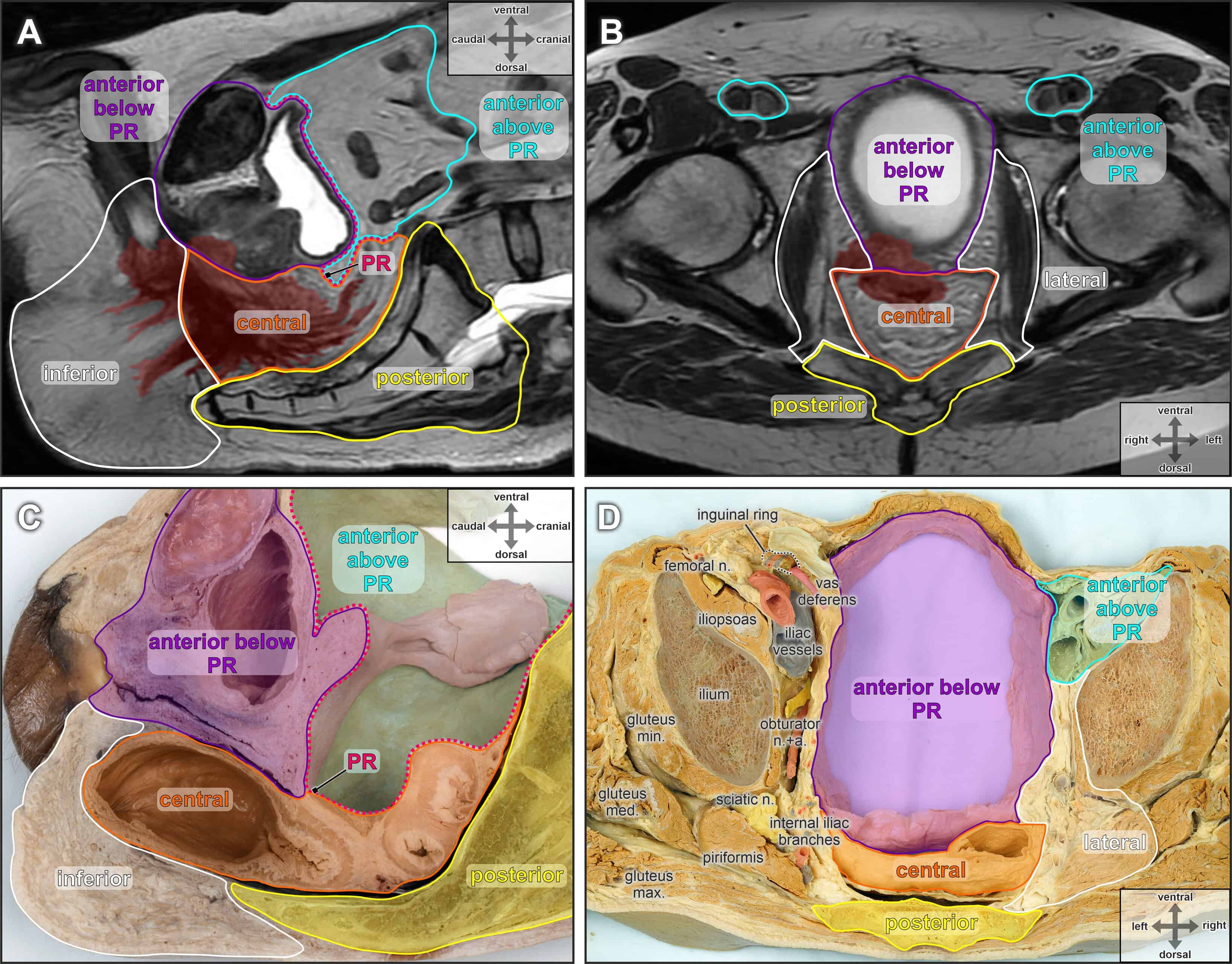 Beyond Total Mesorectal Excision - Anatomische Gesellschaft